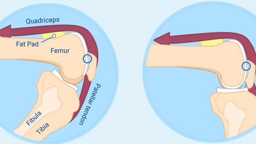 patellofemoral joint dysfunction