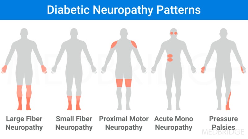 Peripheral Neuropathies Part 2: Management of Common Presentations ...