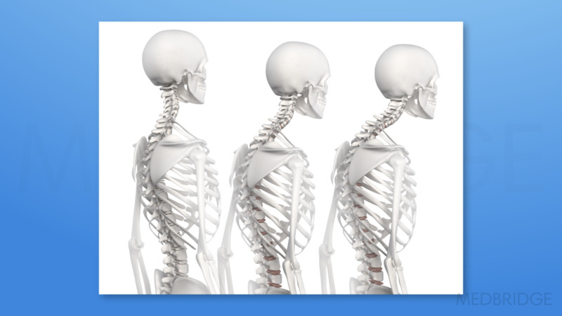 Common Spinal Pathologies in Pediatric and Adolescent Patients | Medbridge