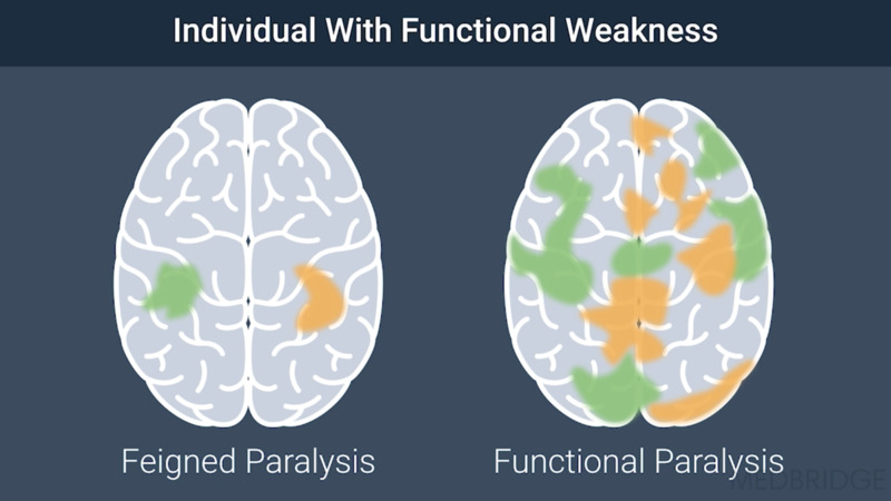 Functional Neurological Disorders: Examination, Diagnosis, and ...
