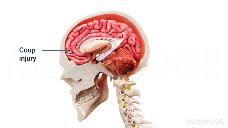 Evaluating and Treating Concussions in the Adolescent Athlete | Medbridge