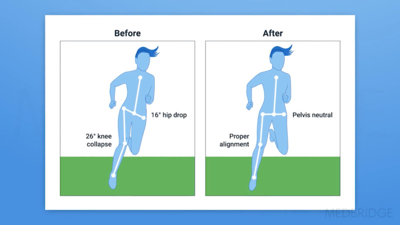 ACL Injury Prevention and Performance Enhancement Program Part 2 | Medbridge