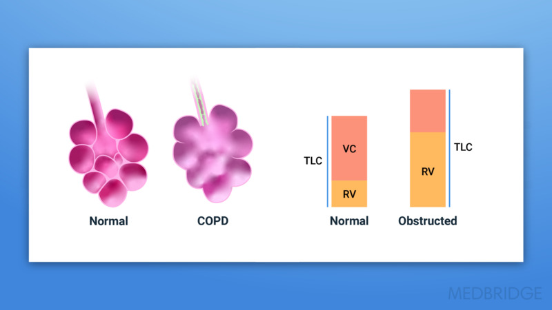 Ventilatory Management of Chronic Obstructive Pulmonary Disease (COPD ...